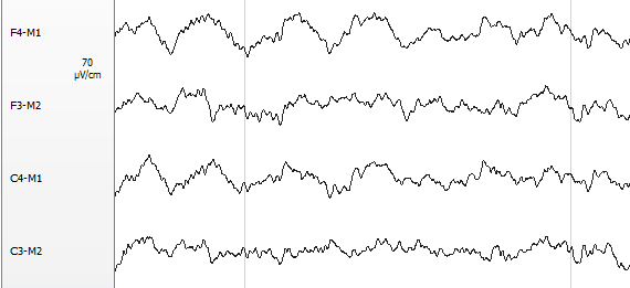 Portable Polysomnography System for Sleep Study – Nox A1 PSG System